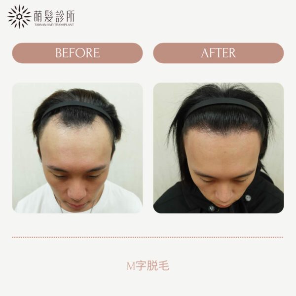 M-shaped hairline - Taiwan Hair Transplant
